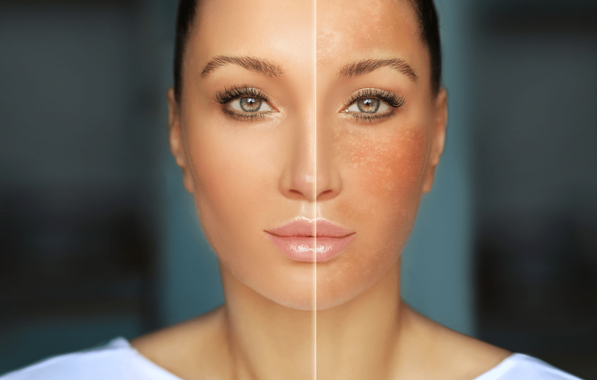 Melasma During Pregnancy: Causes, Prevention, and Post-Birth Treatments ...